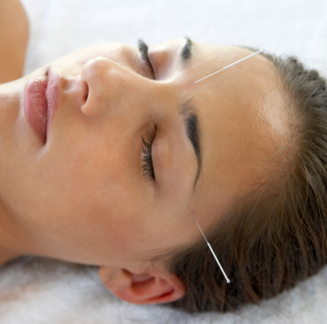 Medical Acupuncture - Our Skin Clinic